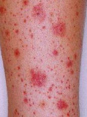 Autoimmune Vasculitis Types