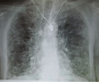 DMARD Success in Myositis-Related Interstitial Lung Disease | RheumNow
