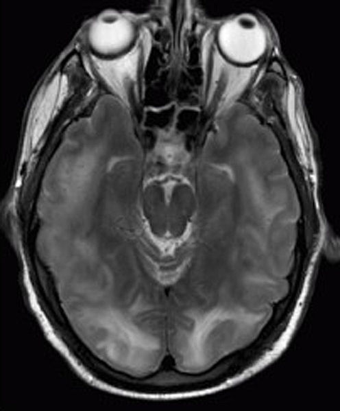 Posterior Reversible Encephalopathy in Lupus | RheumNow