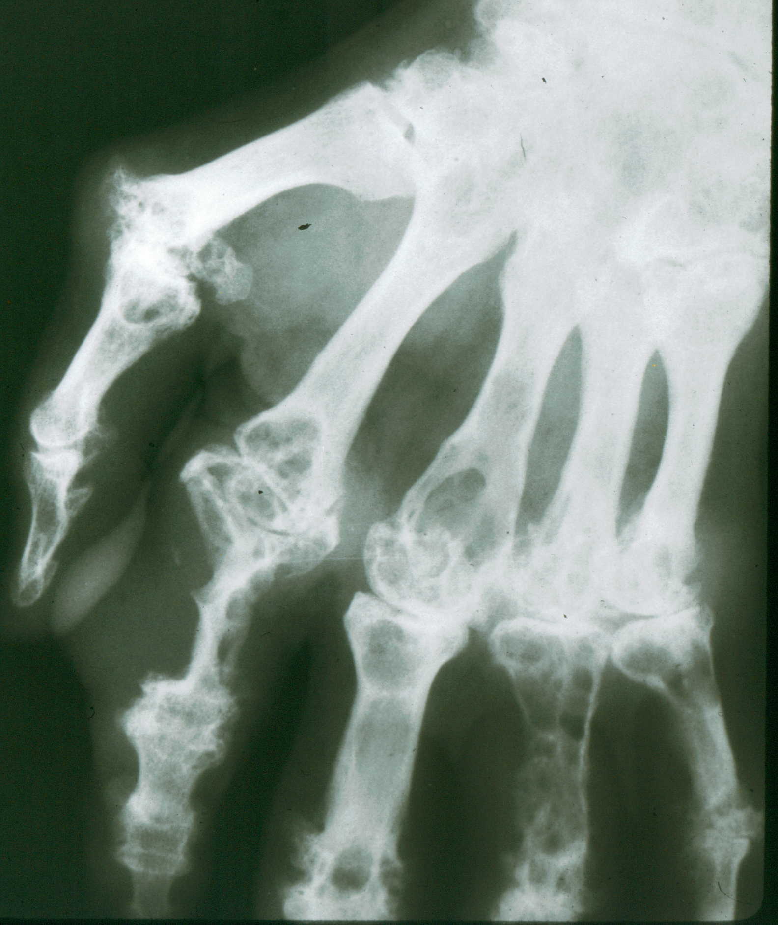 Gout: New Classification Criteria from ACR/EULAR | RheumNow