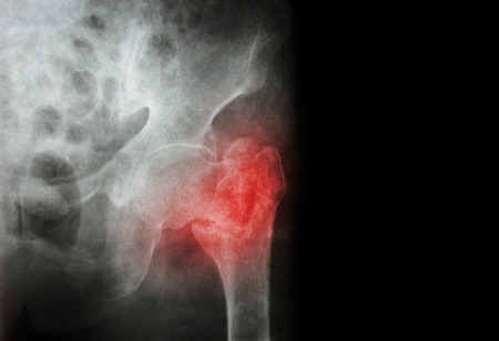 Peripheral Nerve Blocks for Hip Fractures | RheumNow