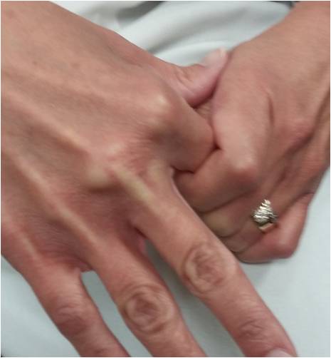 Knuckle Cracking Good News | RheumNow