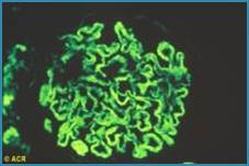 Trends and Innovations in Lupus Nephritis Clinical Trials | RheumNow
