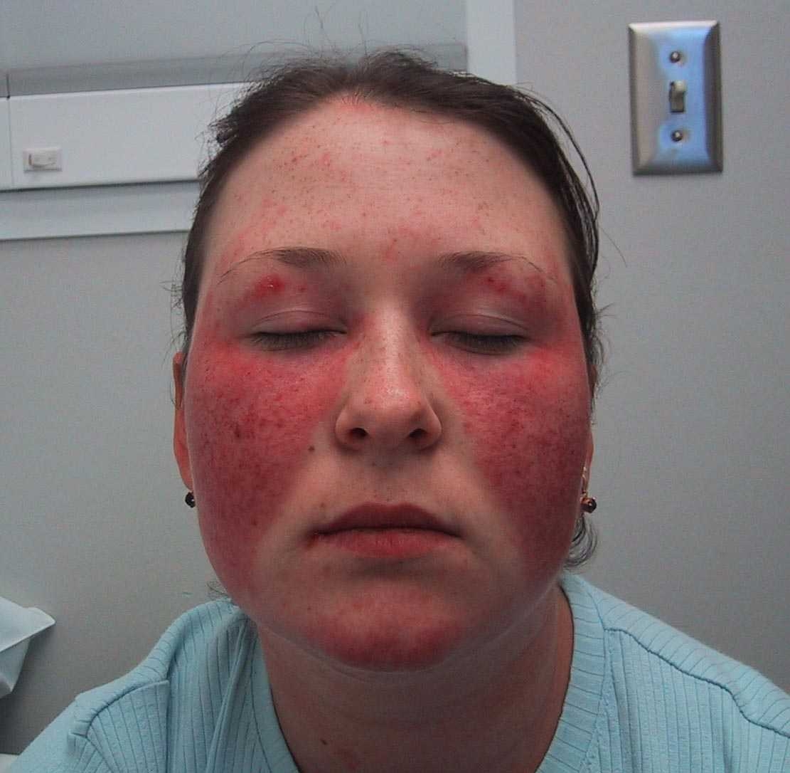 Cachexia Common in Lupus | RheumNow