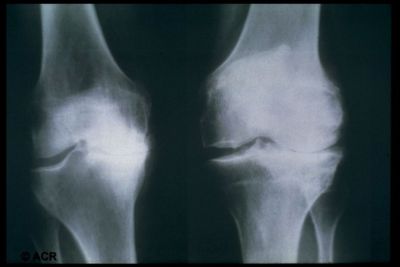 CRTAC1- a Novel Biomarker for Osteoarthritis | RheumNow