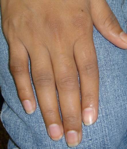 PAFLAR Guidelines for Polyarticular Juvenile Idiopathic Arthritis ...