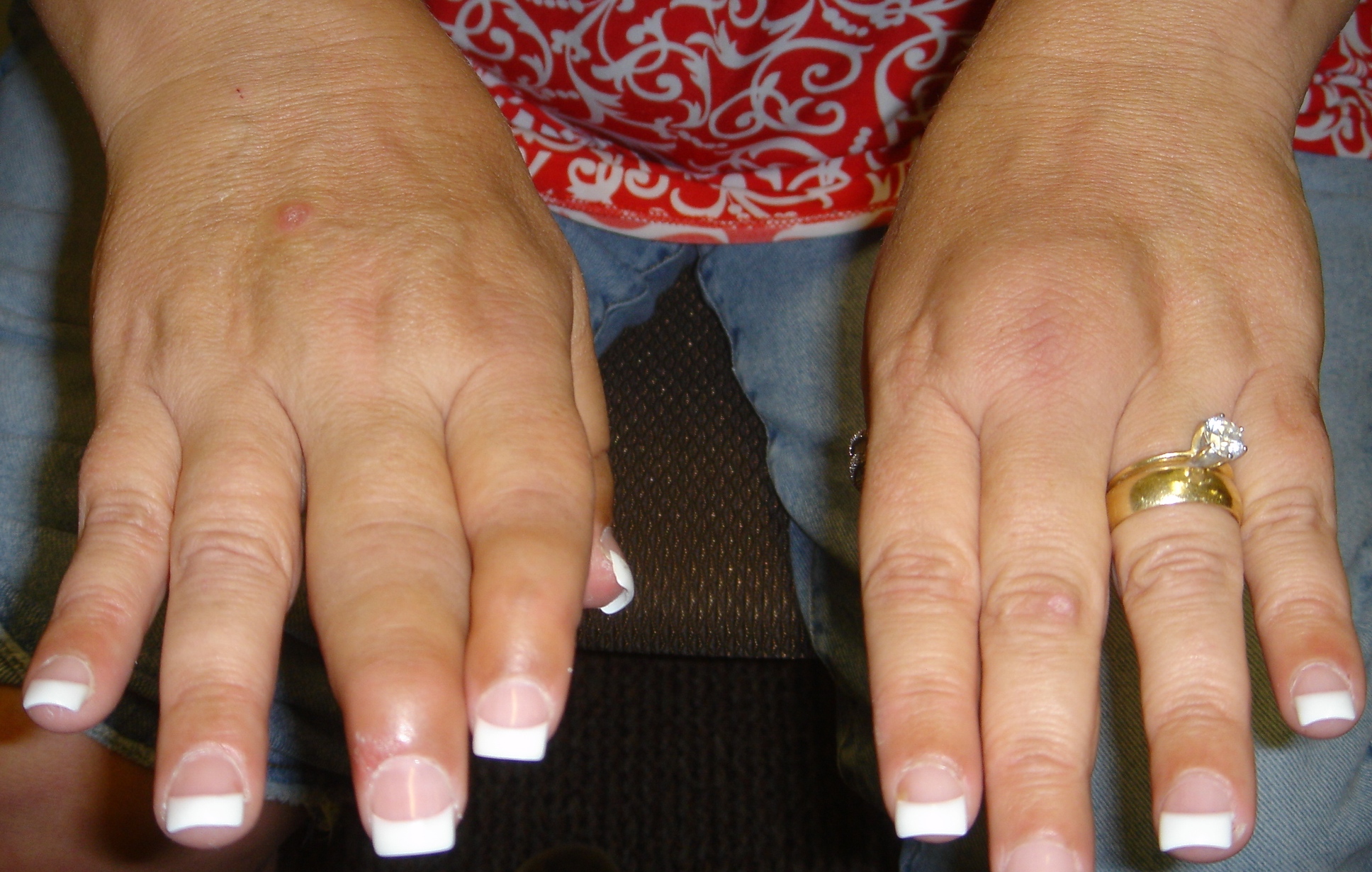 Brepocitinib in Active Psoriatic Arthritis | RheumNow