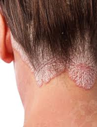 BMS Tyk 2 Inhibitor Benefits Psoriasis | RheumNow