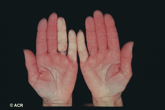 Scleroderma Raynaud's May Worsen in Summer | RheumNow