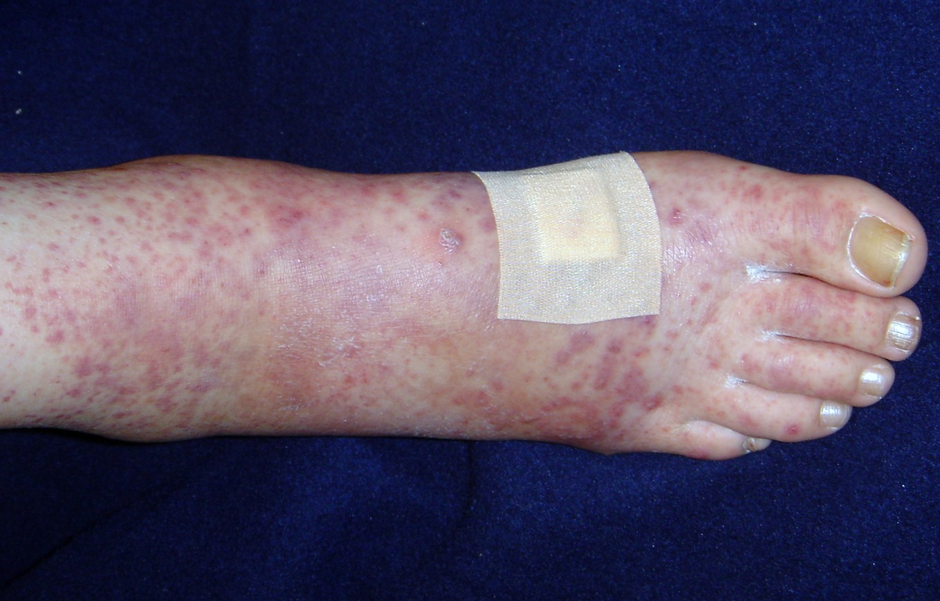 Livedo, Purpura and Coagulopathy in Severe COVID-19 | RheumNow