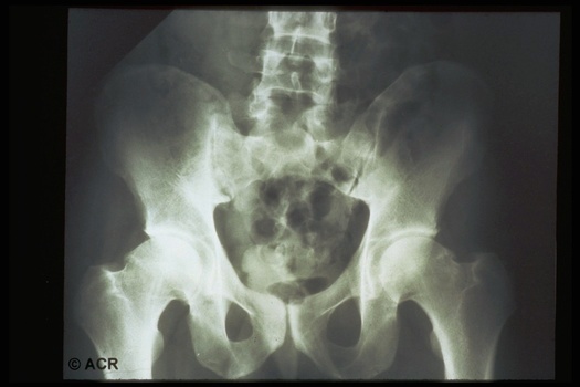 Update to Axial Spondyloarthritis Guidance | RheumNow