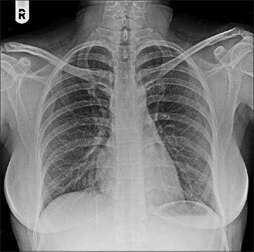 Specific ACPAs and Autoantibodies Lead to RA-Associated ILD | RheumNow