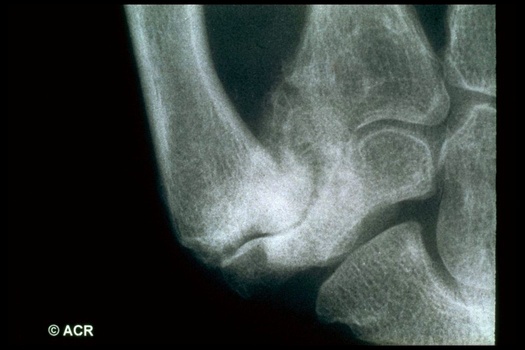 Little Effect with Multimodal Treatment of CMC1 Osteoarthritis | RheumNow