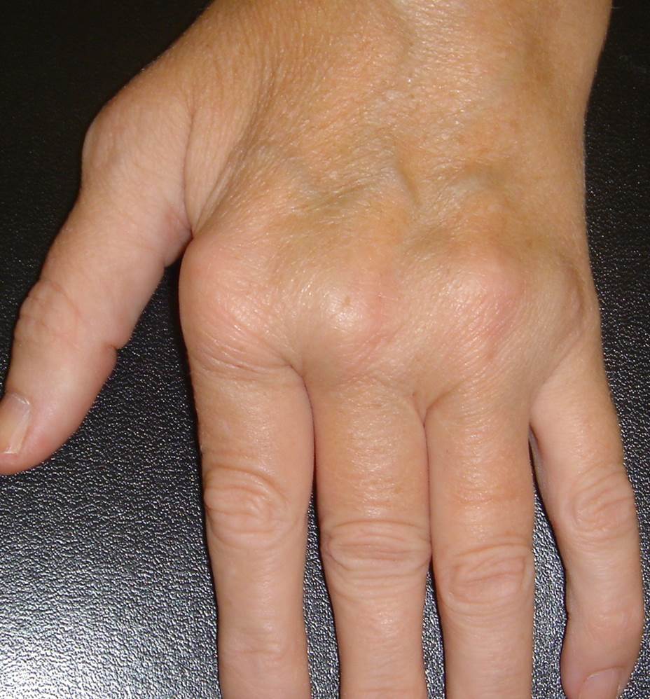 New 2022 EULAR Recommendations for the Management of Rheumatoid Arthritis | RheumNow