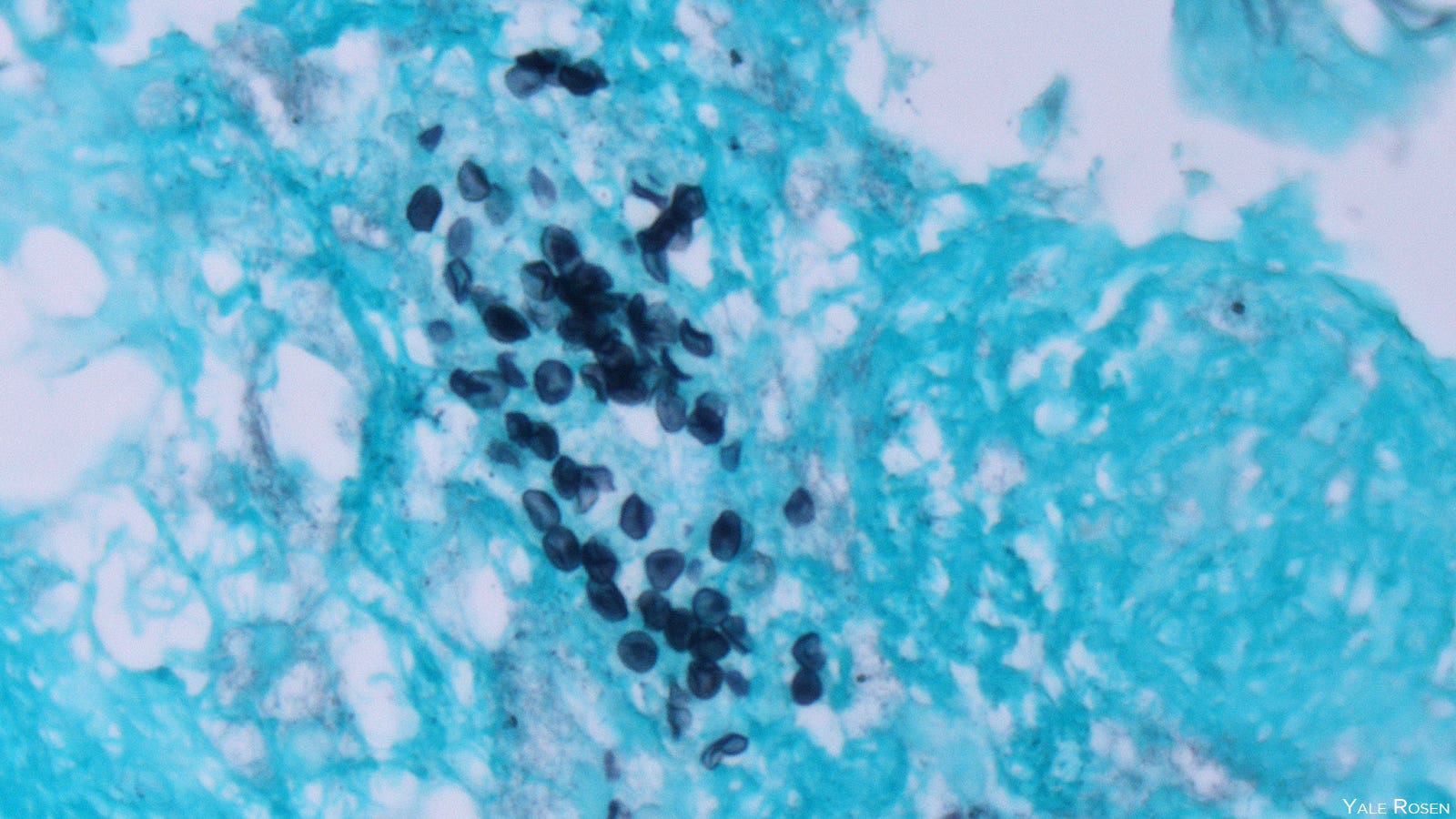 Pneumocystis Often Lethal in Dermatomyositis | RheumNow