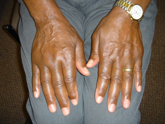 Best Treatments for Immune Checkpoint Inhibitor-associated Arthritis ...