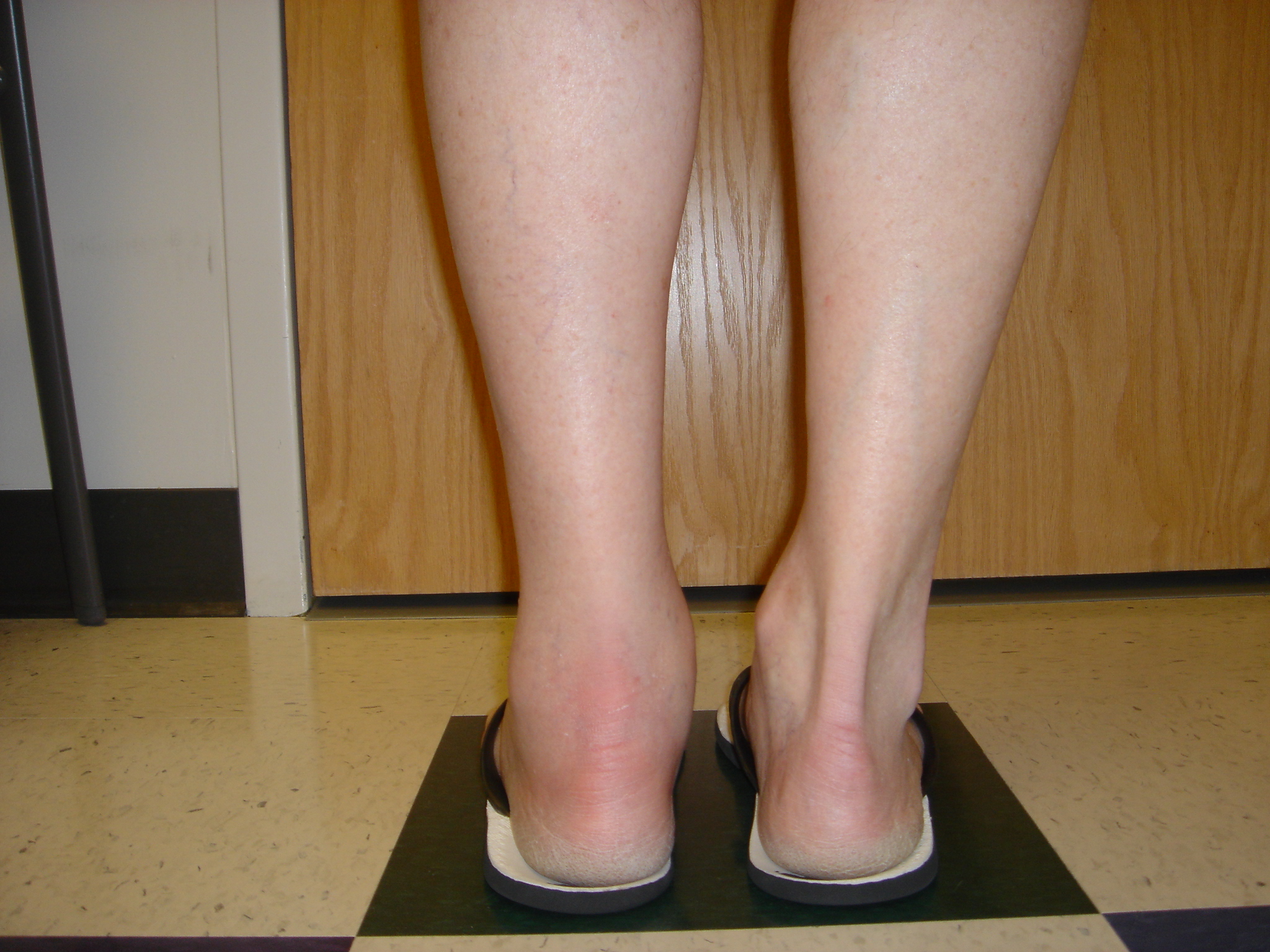 MSK Symptoms from Dupilimab, an IL-4/13 Inhibitor | RheumNow