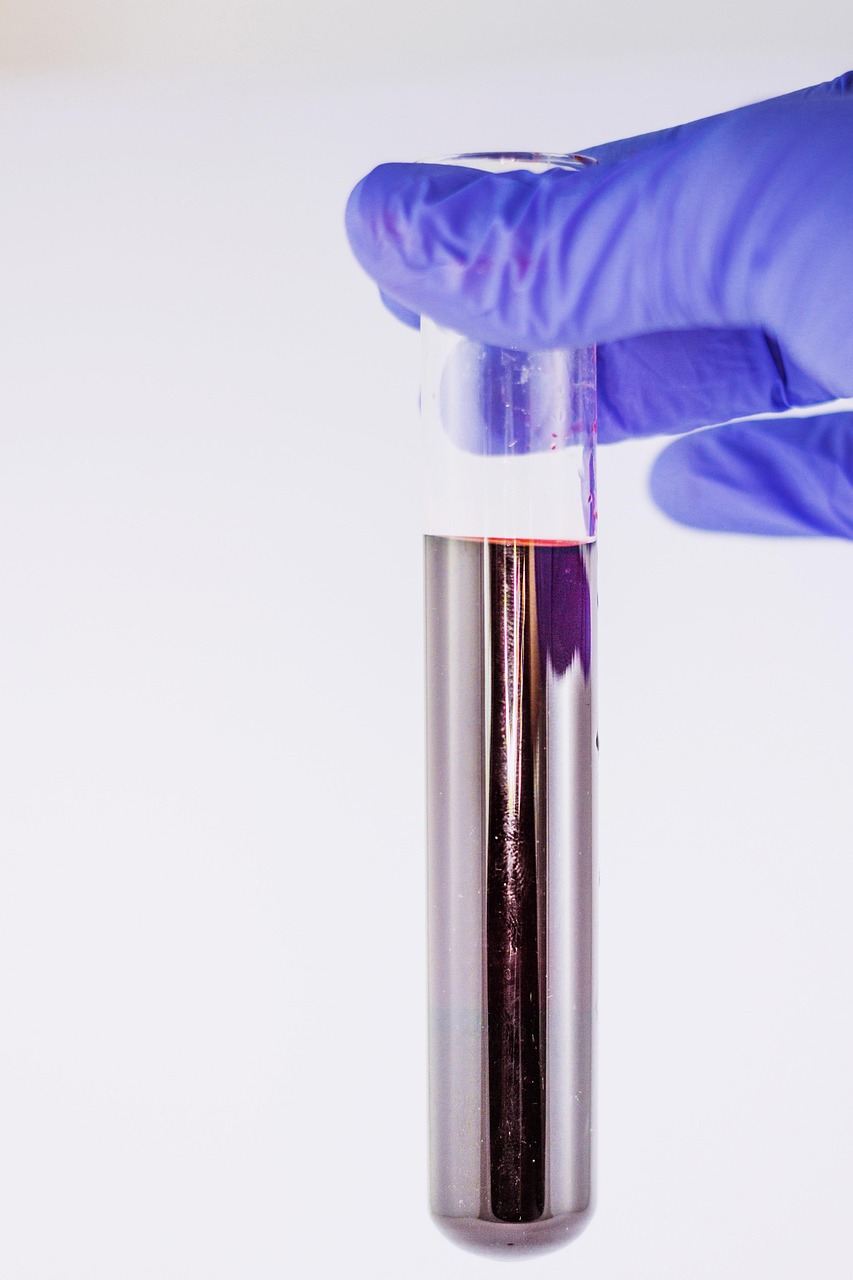 HLA-B27 Testing in Practice | RheumNow