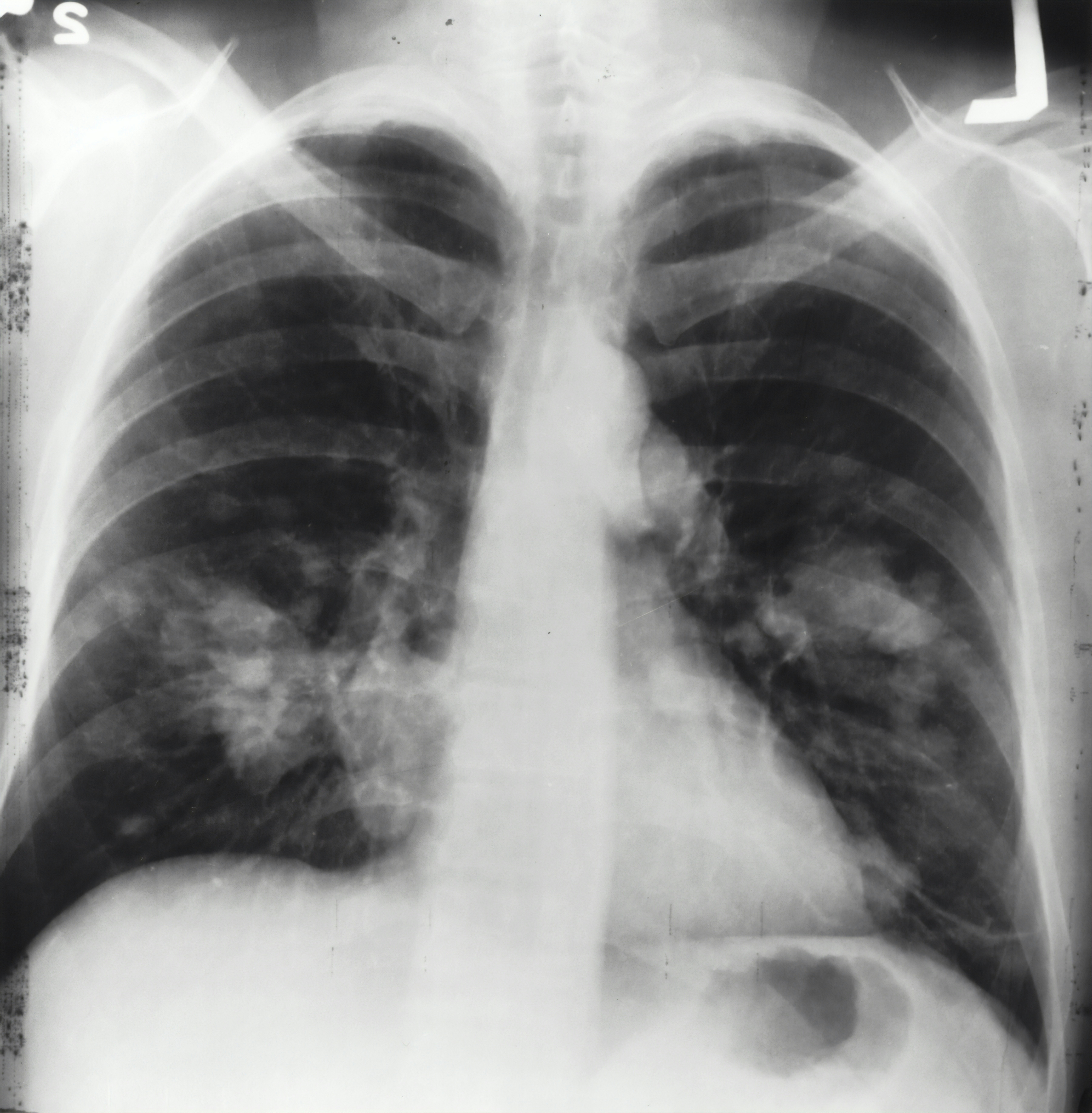 Interstitial Lung Disease and Lung Cancer Risk | RheumNow
