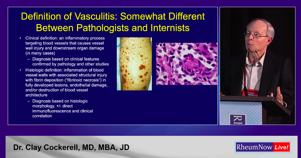 Vasculitis | RheumNow