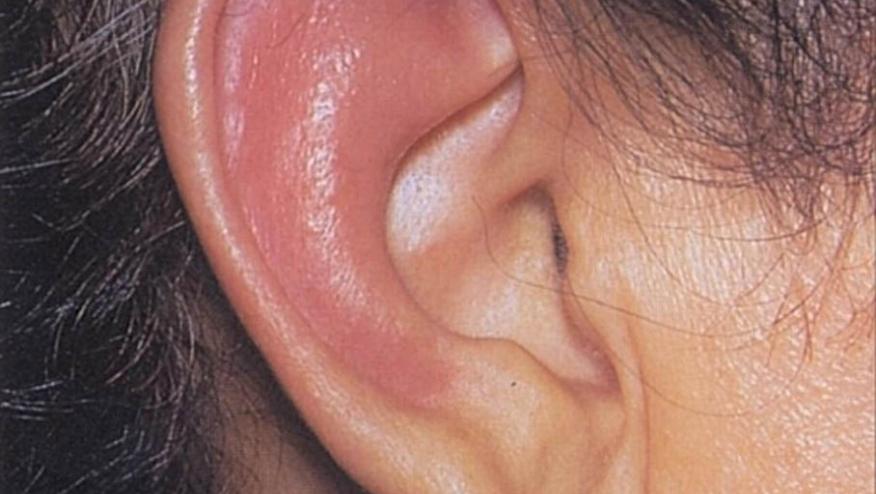 Because It's Rare Doesn’t Mean It Doesn’t Exist: A Tribute to Relapsing ...