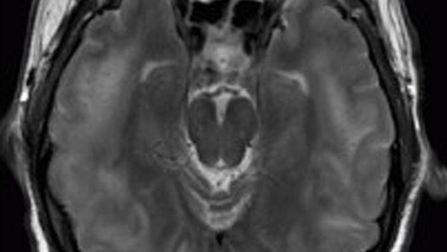 Posterior Reversible Encephalopathy in Lupus | RheumNow
