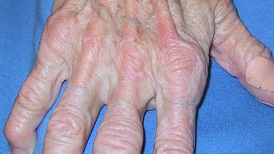 Heberden’s Nodes Predict Knee OA Progression | RheumNow