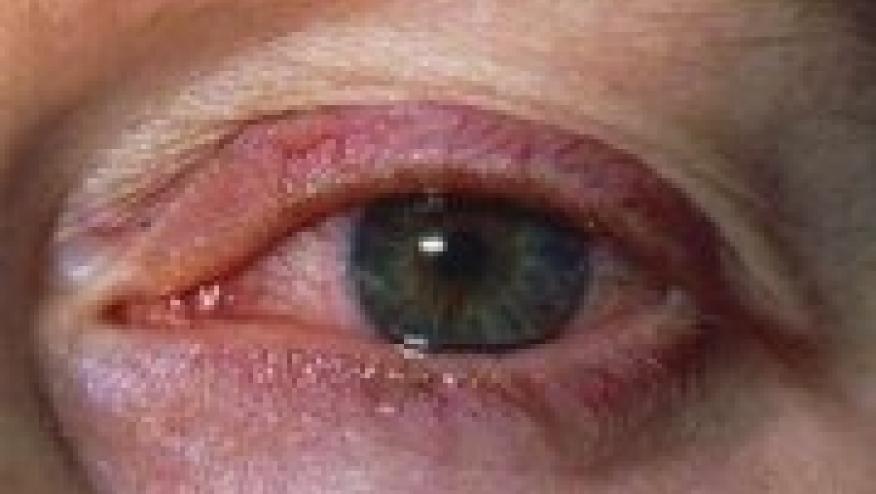 TNF Inhibitor Therapy and the Risk of Anterior Uveitis Recurrence ...