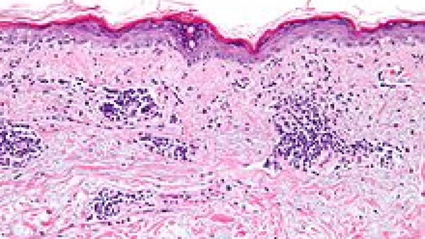 Type I Interferon Drives Photosensitivity in Cutaneous Lupus | RheumNow