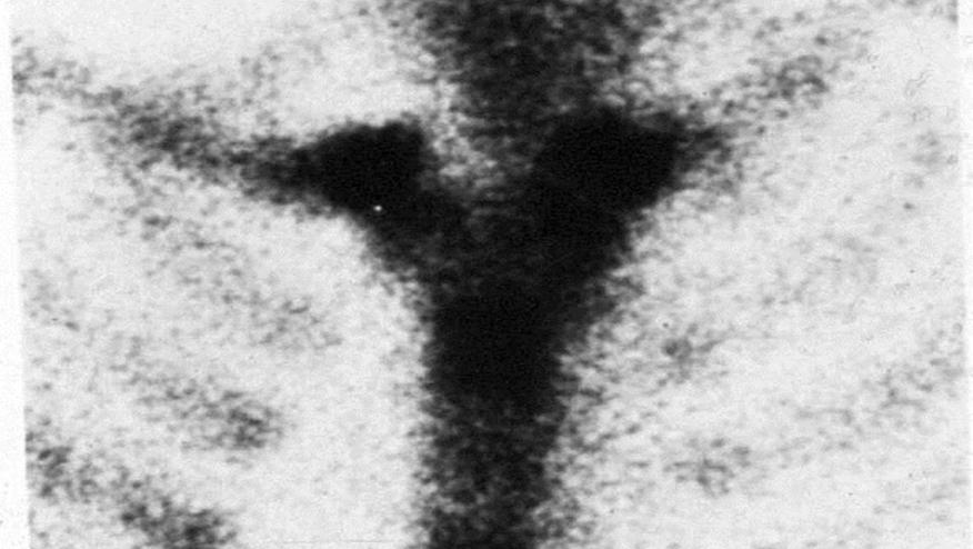 SAPHO Syndrome Revisted | RheumNow