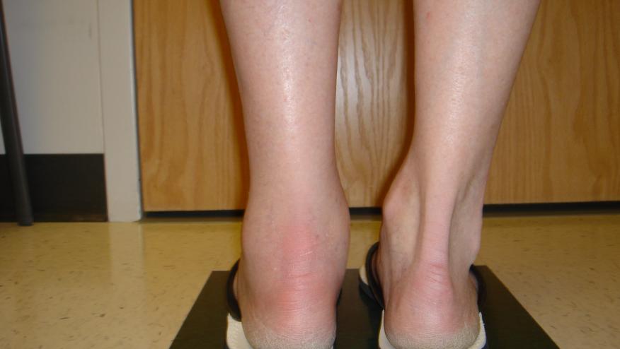 Enthesitis-Related Arthritis in Children | RheumNow