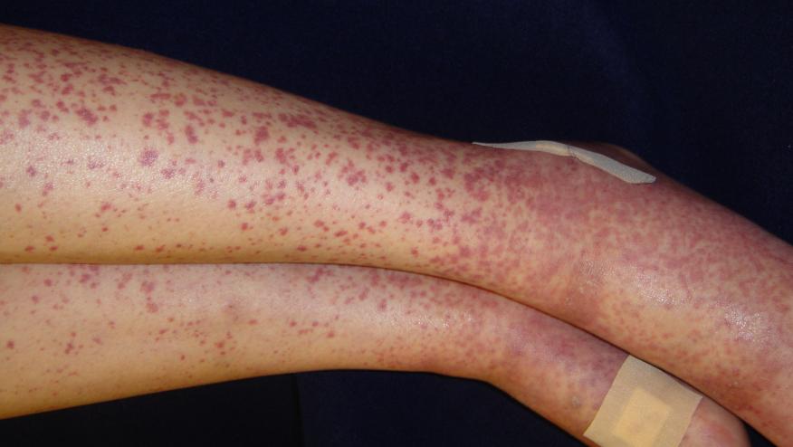 Cryoglobulinemic Vasculitis Reviewed | RheumNow