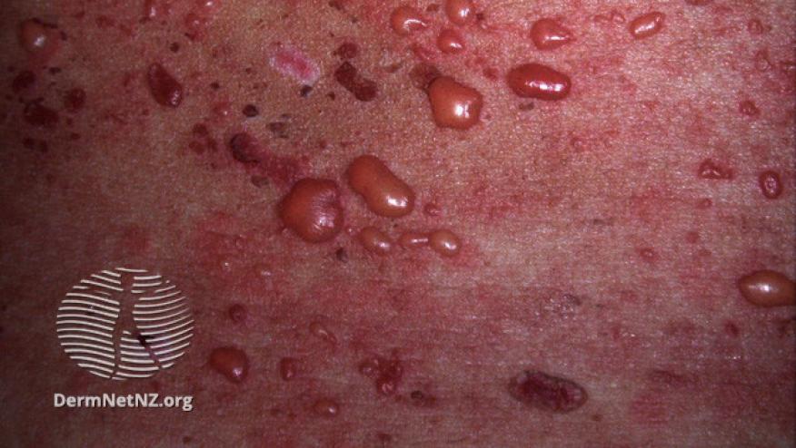 Bullous Systemic Lupus Erythematosus Rheumnow