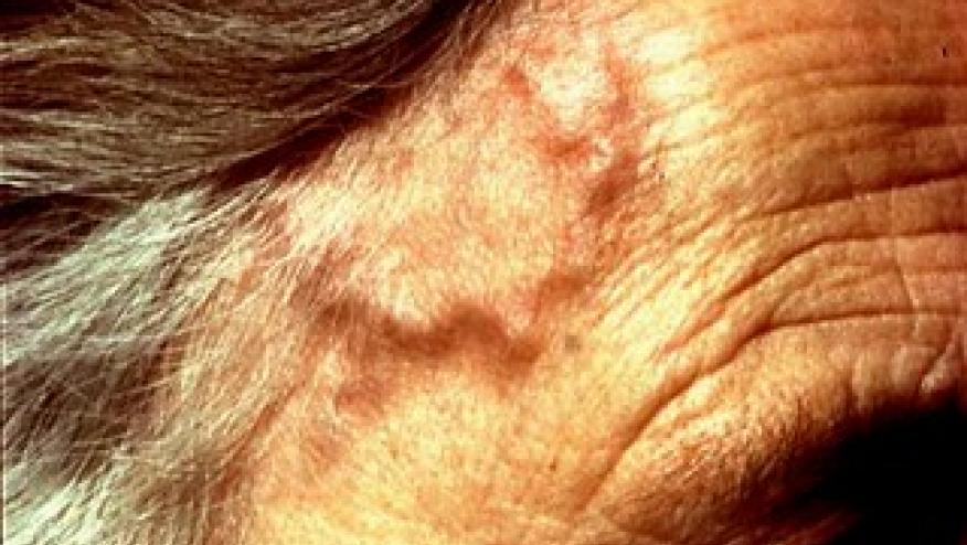 2022 ACR/EULAR Giant Cell Arteritis Classification Criteria | RheumNow