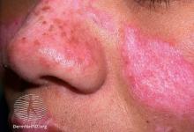 Combination DMARD for Lupus Nephritis: Dr. Kathryn Dao | RheumNow