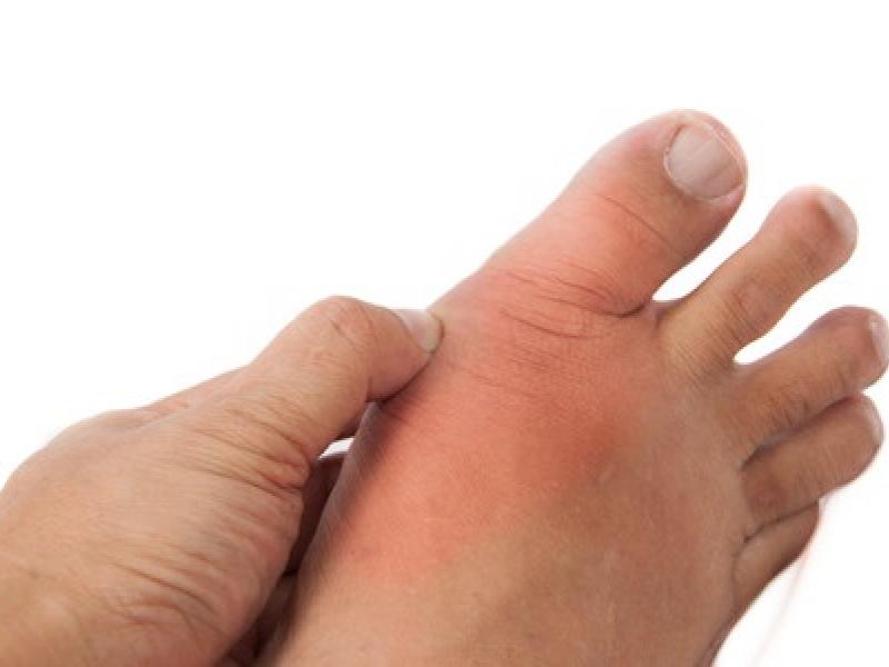 Gout-ACR 2020 | RheumNow
