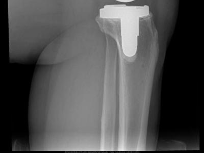 Commercial claims analysis of 21,044 pts w/ simultaneous B/L TKA vs ...
