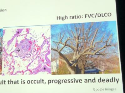 RT @Janetbirdope: Slow pruning of Pulmonary arteries occurs way before ...